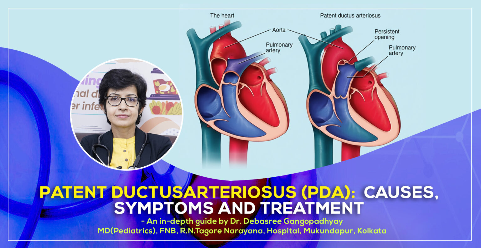 Patent Ductus Arteriosus (PDA): Causes, Symptoms and Treatment in Kolkata